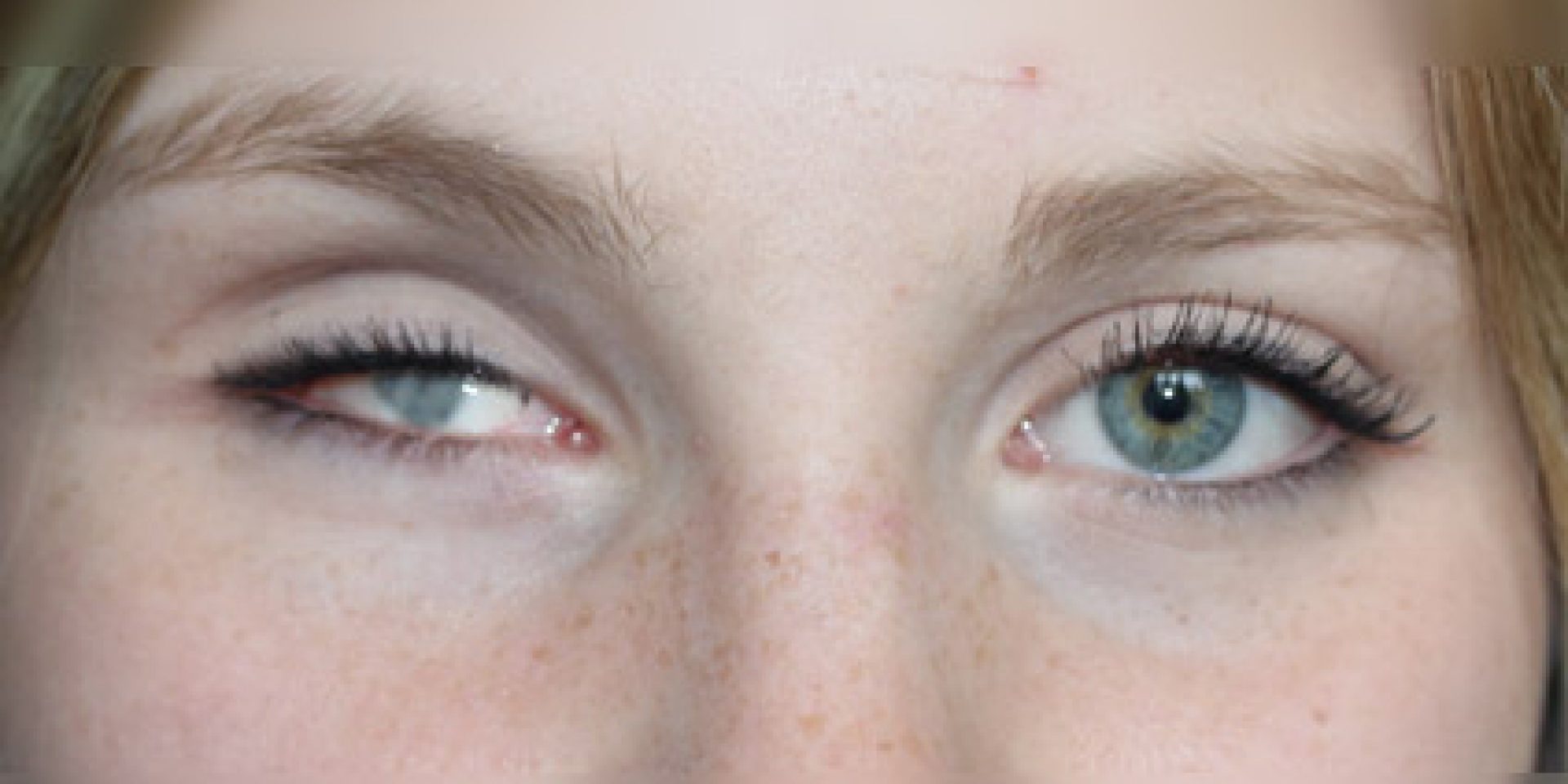 Trauma oculare - DCM oculariste svizzero