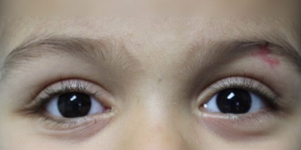 Appareillage oculaire chez l'enfant - DCM-oculariste