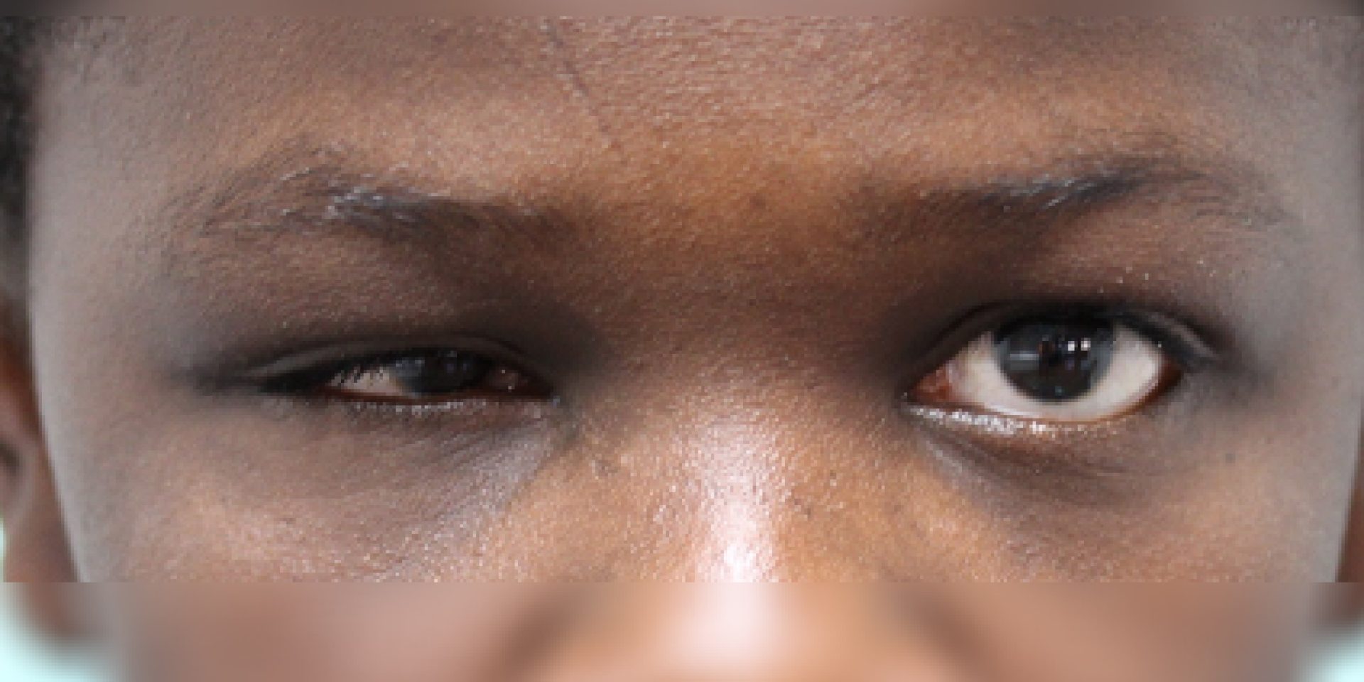 Eye injury - DCM Ocularist Geneva